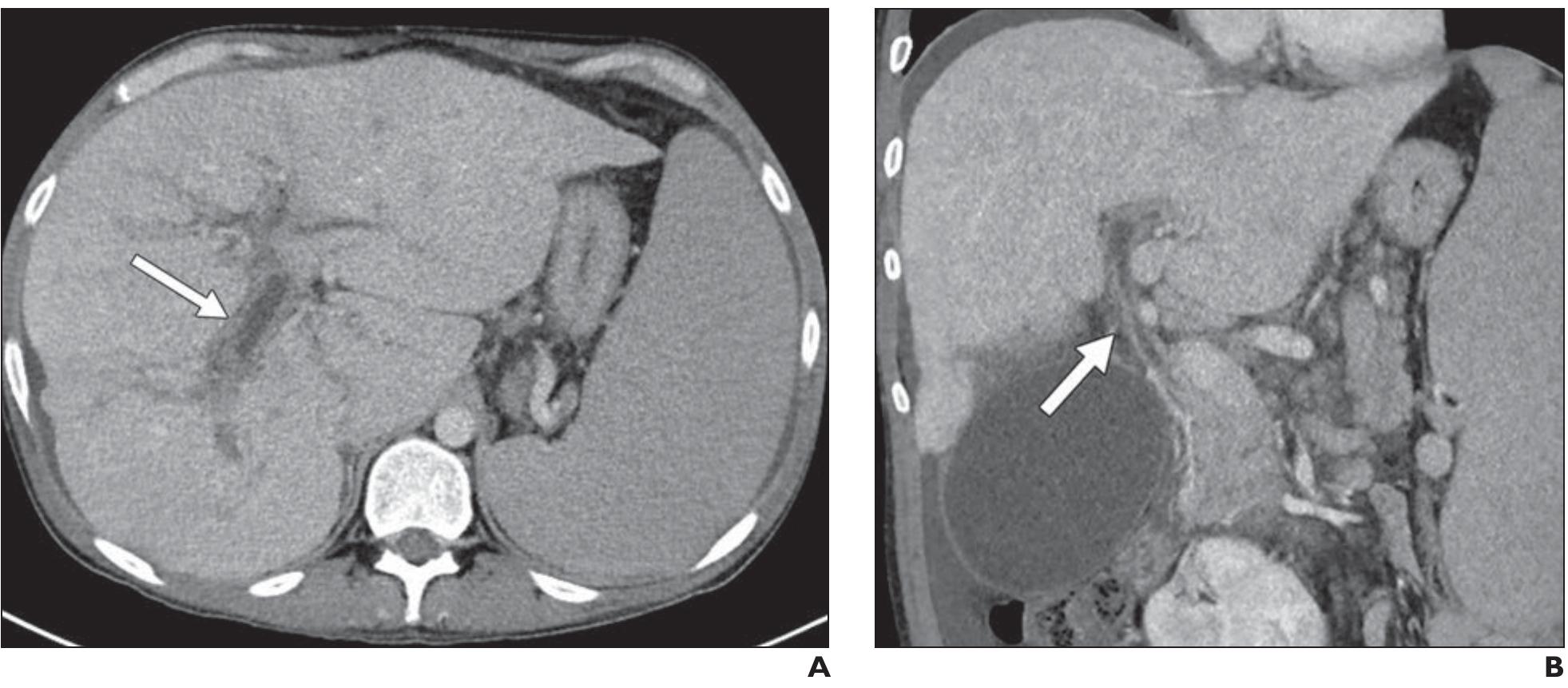 (PDF) Abnormalities of the Distal Common Bile Duct and Ampulla ...