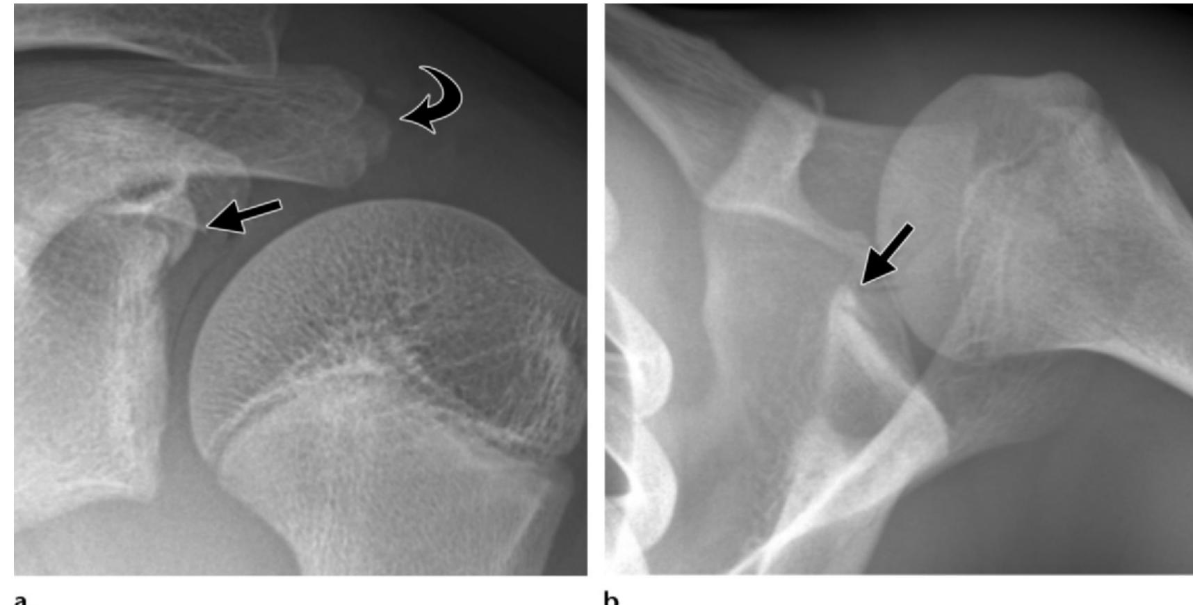 Normal proximal humeral growth plate in a 13-year-old boy.