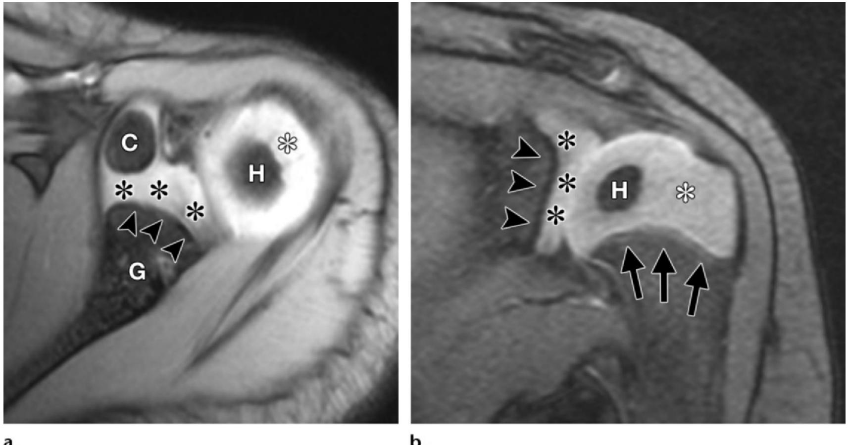 (PDF) Normal Skeletal Maturation and Imaging Pitfalls in the Pediatric ...