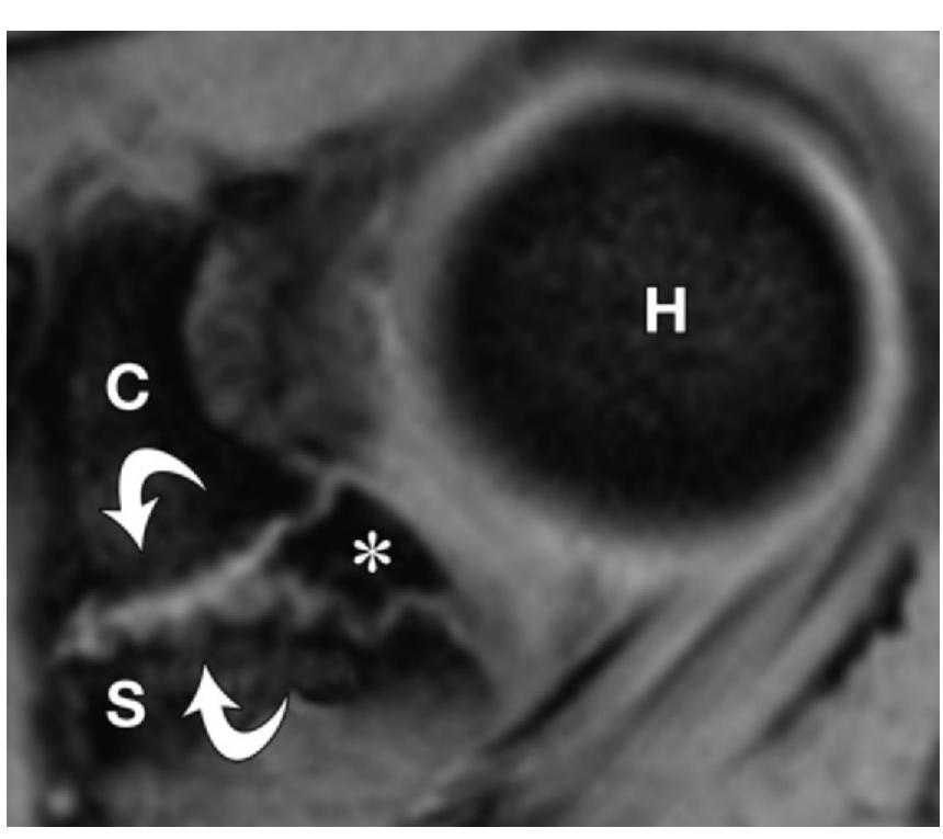 Normal proximal humeral growth plate in a 13-year-old boy.