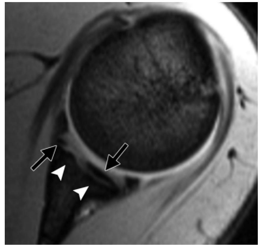 Normal proximal humeral growth plate in a 13-year-old boy.