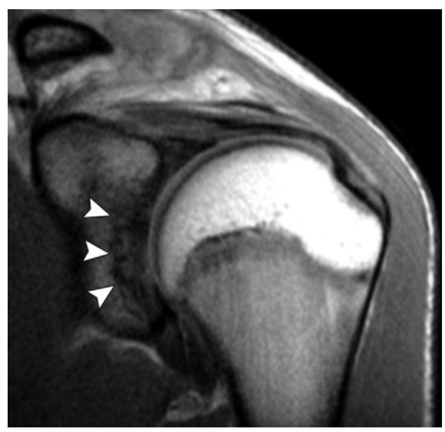 (PDF) Normal Skeletal Maturation and Imaging Pitfalls in the Pediatric ...