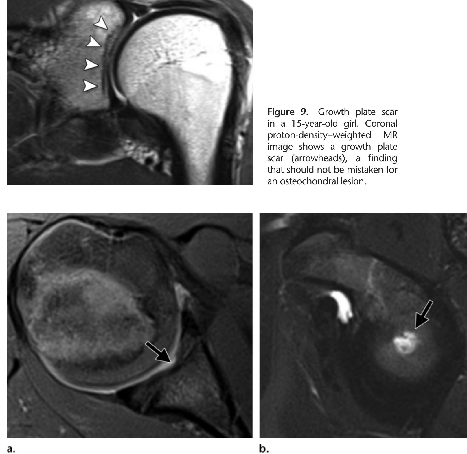 Normal proximal humeral growth plate in a 13-year-old boy.