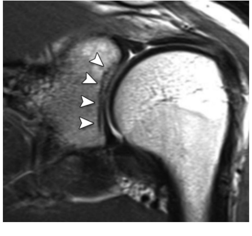 Normal proximal humeral growth plate in a 13-year-old boy.