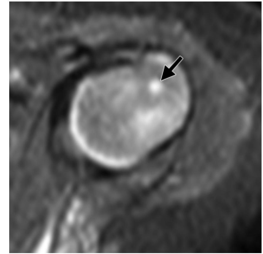Normal proximal humeral growth plate in a 13-year-old boy.