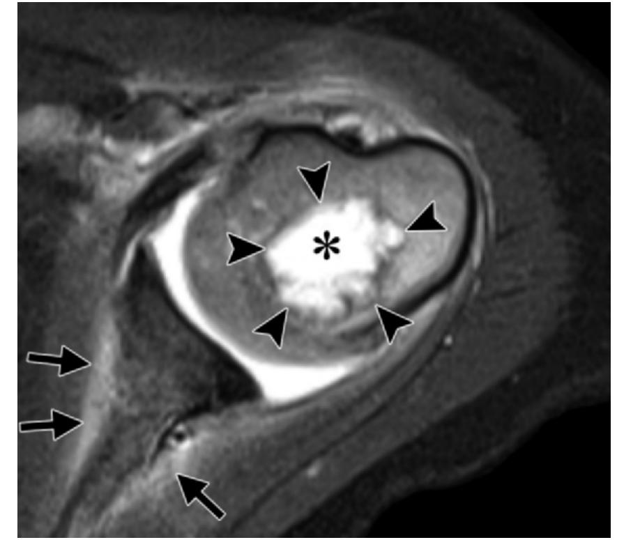 Normal proximal humeral growth plate in a 13-year-old boy.