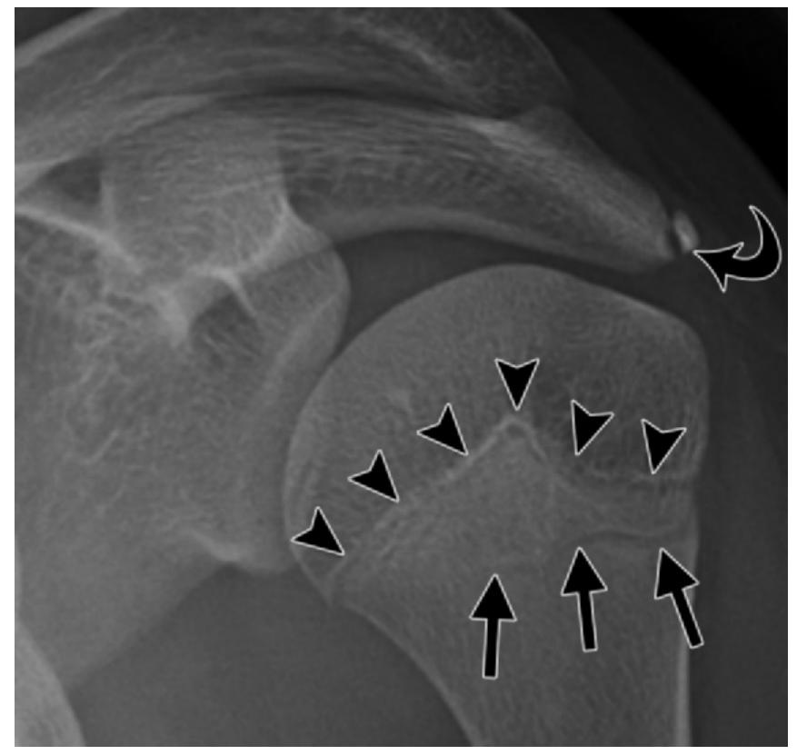Normal proximal humeral growth plate in a 13-year-old boy.