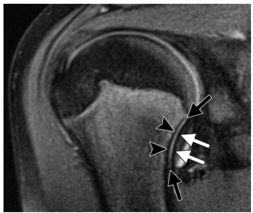 Normal proximal humeral growth plate in a 13-year-old boy.