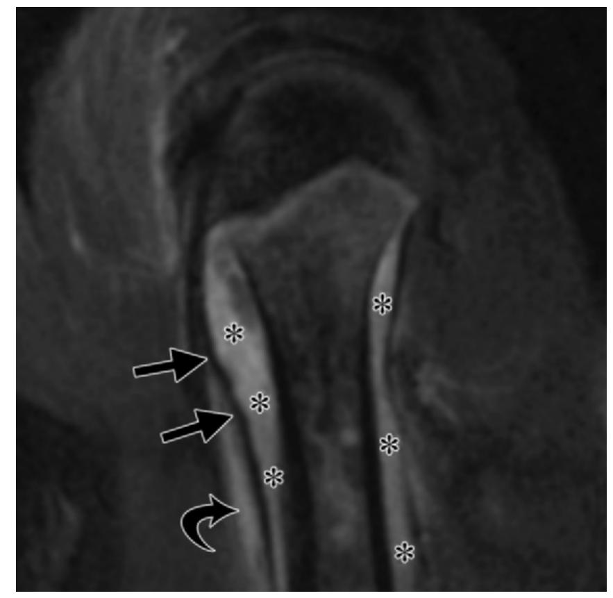Normal proximal humeral growth plate in a 13-year-old boy.
