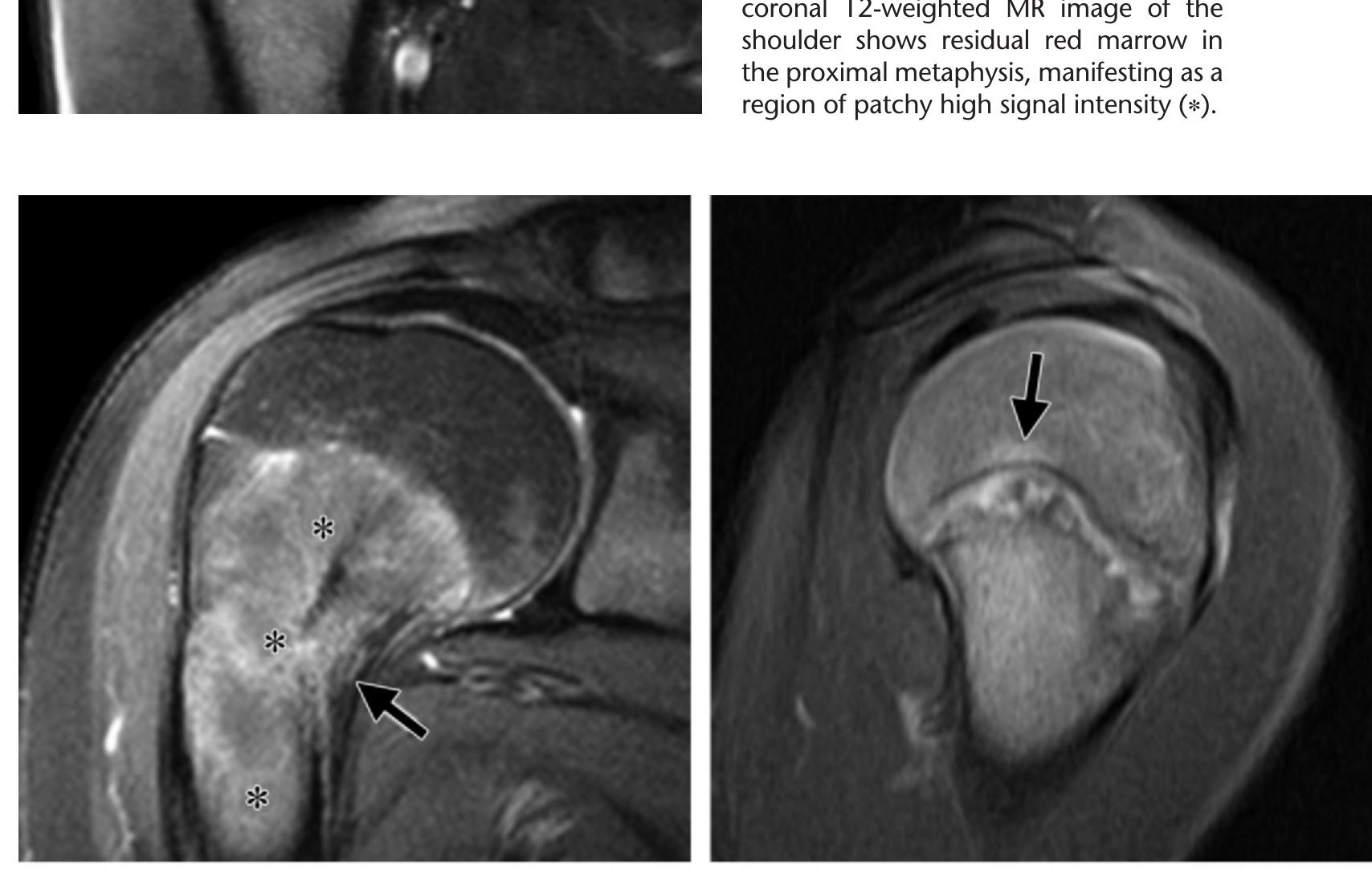 (PDF) Normal Skeletal Maturation and Imaging Pitfalls in the Pediatric ...