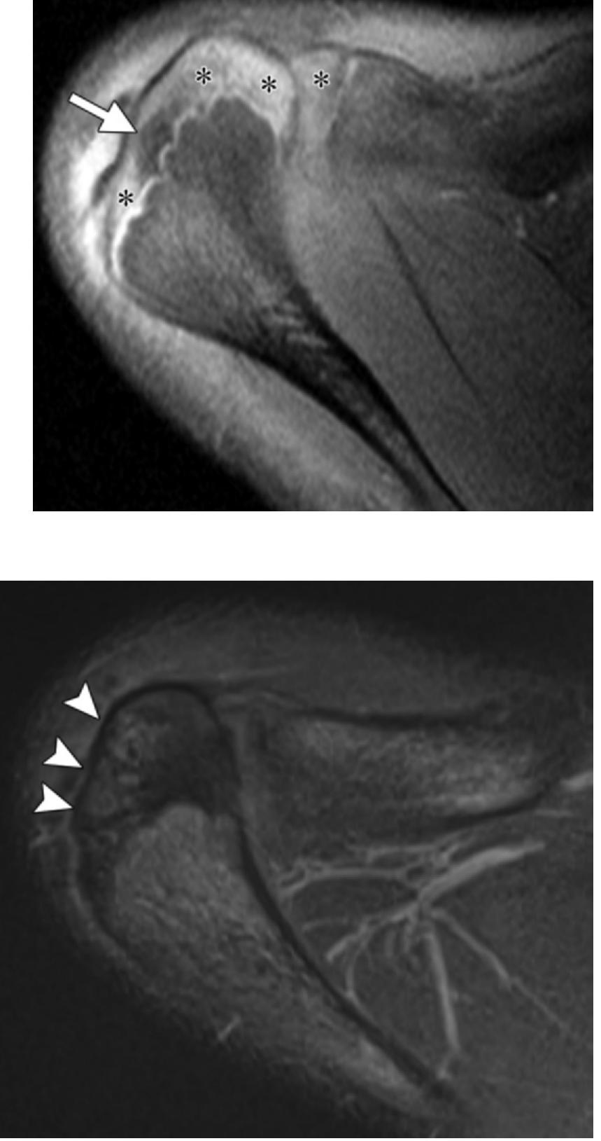 Multiple distal acromial secondary ossifica- tion centers in