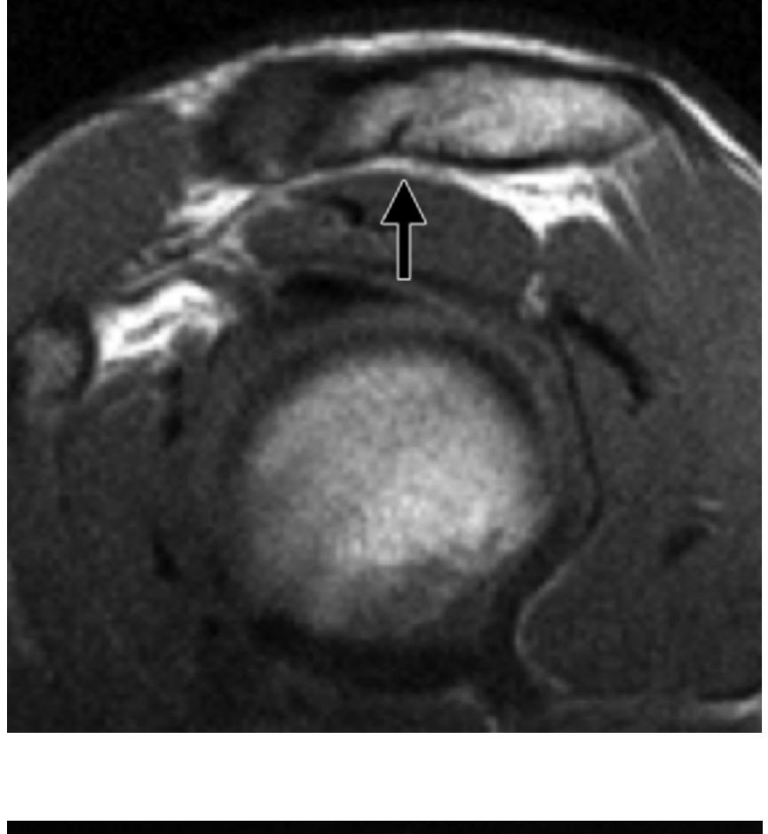 Normal proximal humeral growth plate in a 13-year-old boy.
