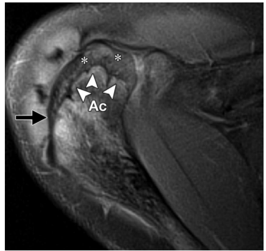 (PDF) Normal Skeletal Maturation and Imaging Pitfalls in the Pediatric ...