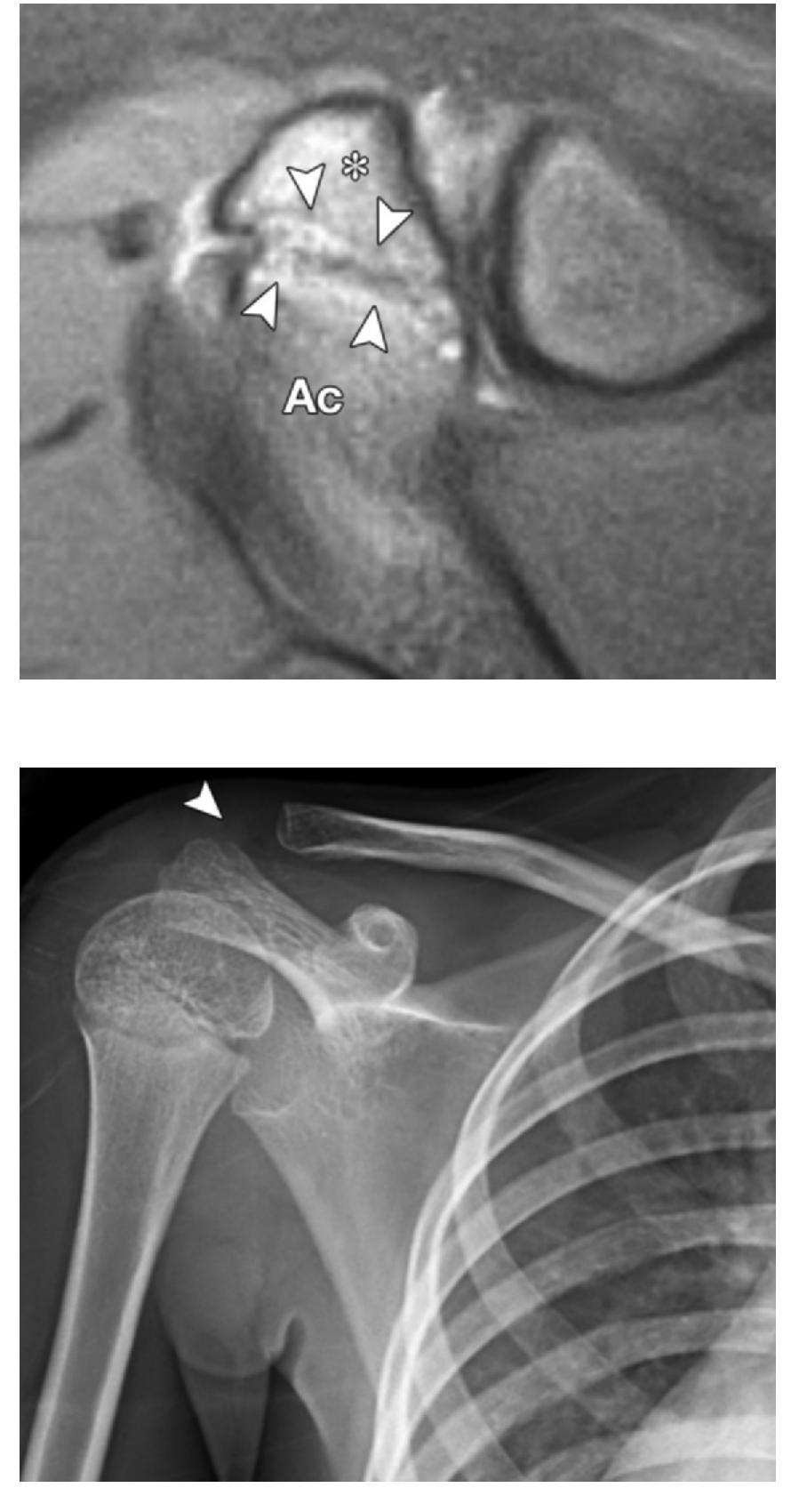 Normal proximal humeral growth plate in a 13-year-old boy.