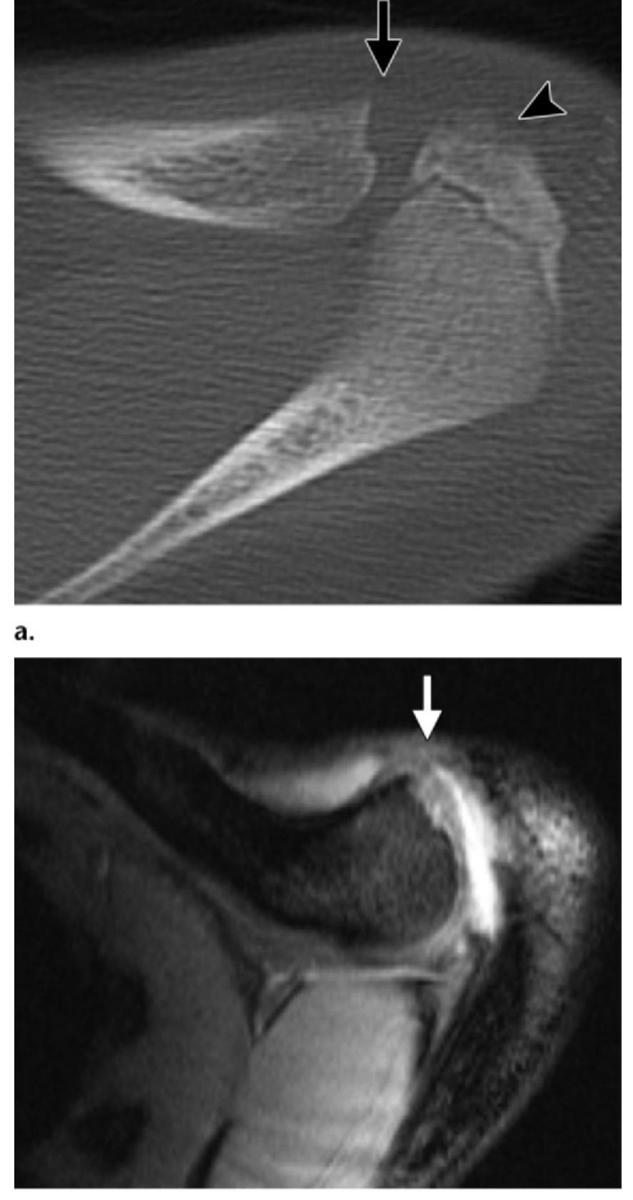 Normal proximal humeral growth plate in a 13-year-old boy.