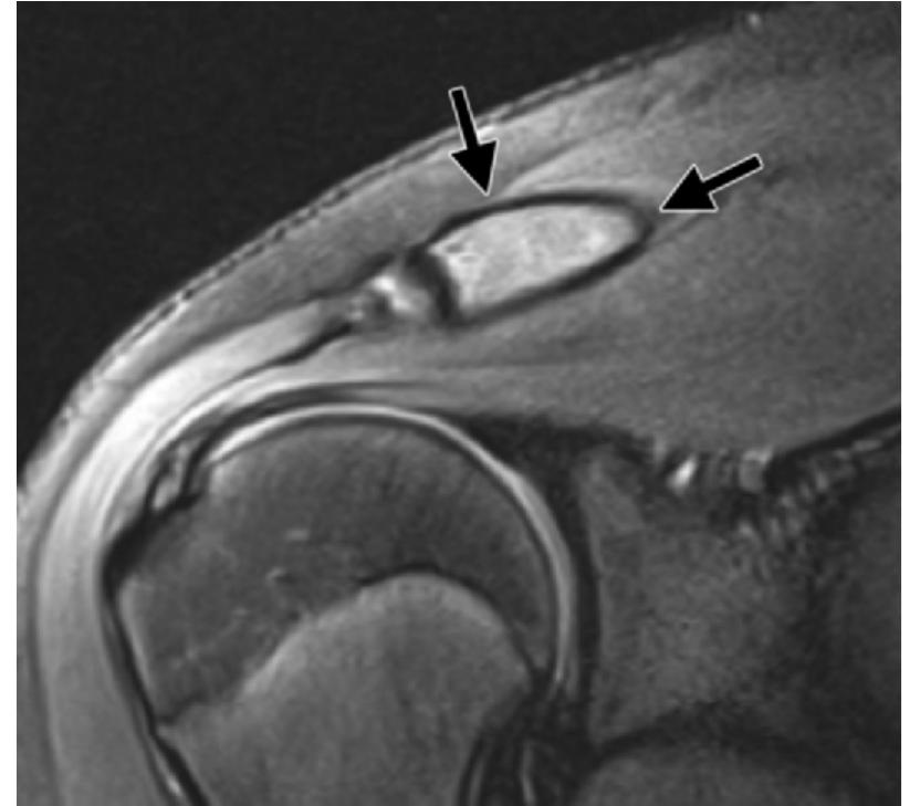 Normal proximal humeral growth plate in a 13-year-old boy.