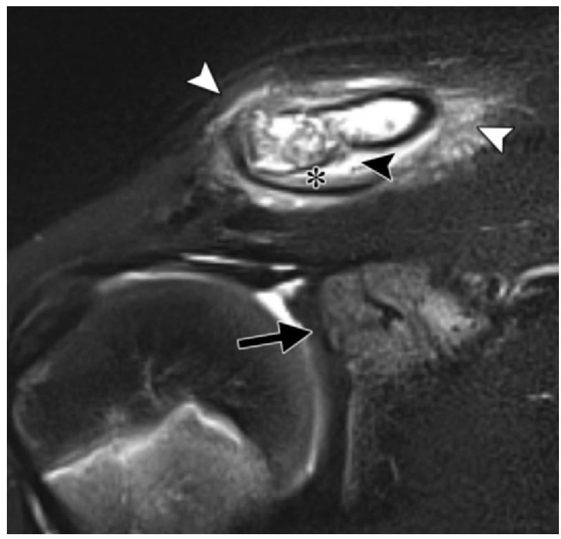 Normal proximal humeral growth plate in a 13-year-old boy.