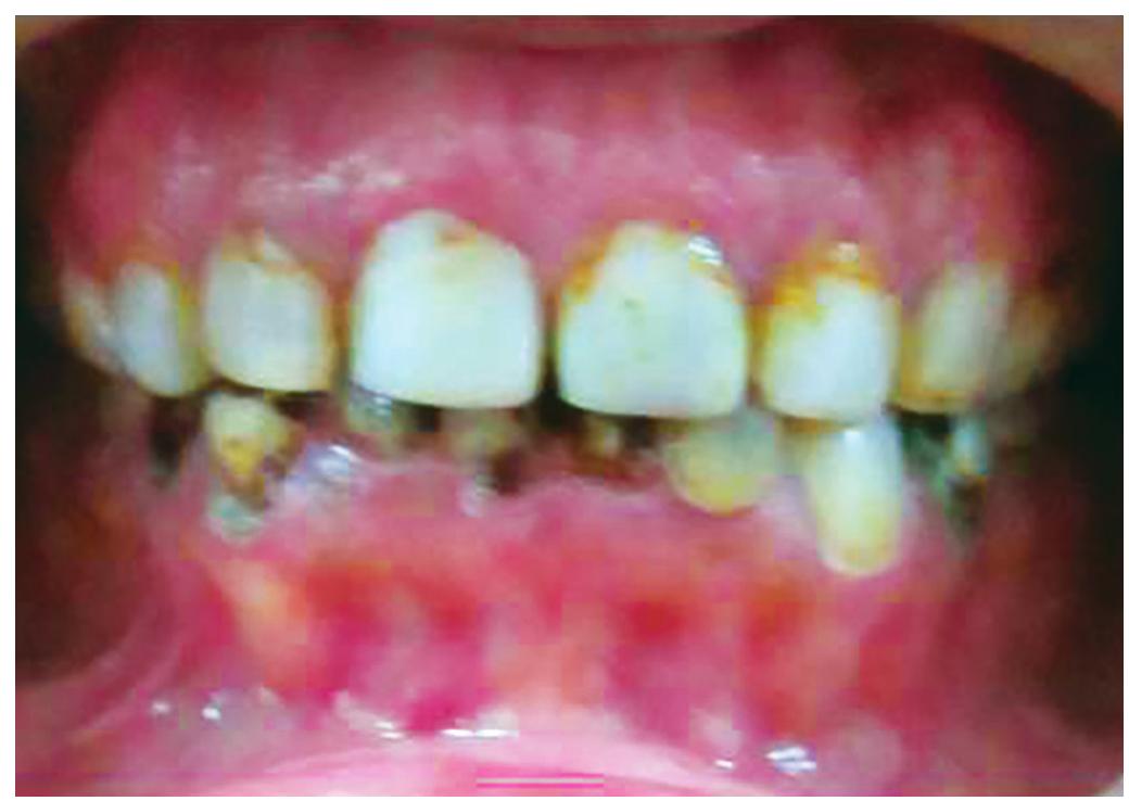 Metal try-in for mandibular teeth management of worn