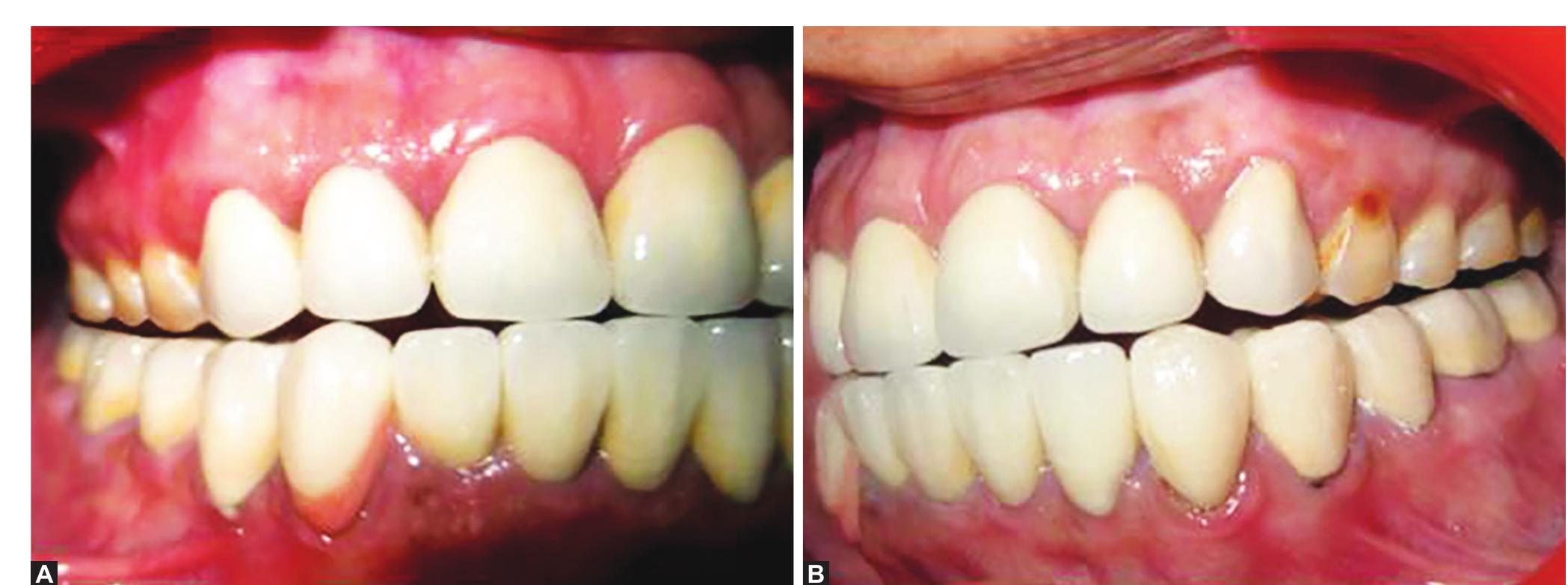 S 8a and b: post-treatment teeth in excursive movement sion