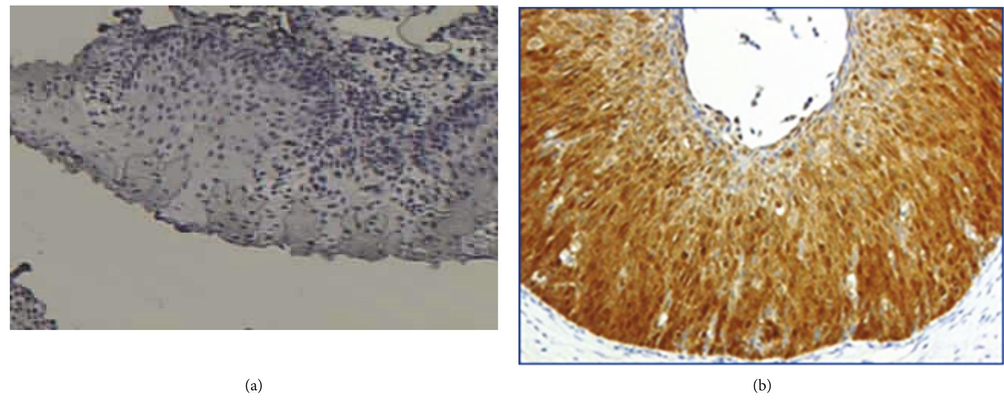 Ficure 3: p16 ihc staining. (a) negative p16 ihc,