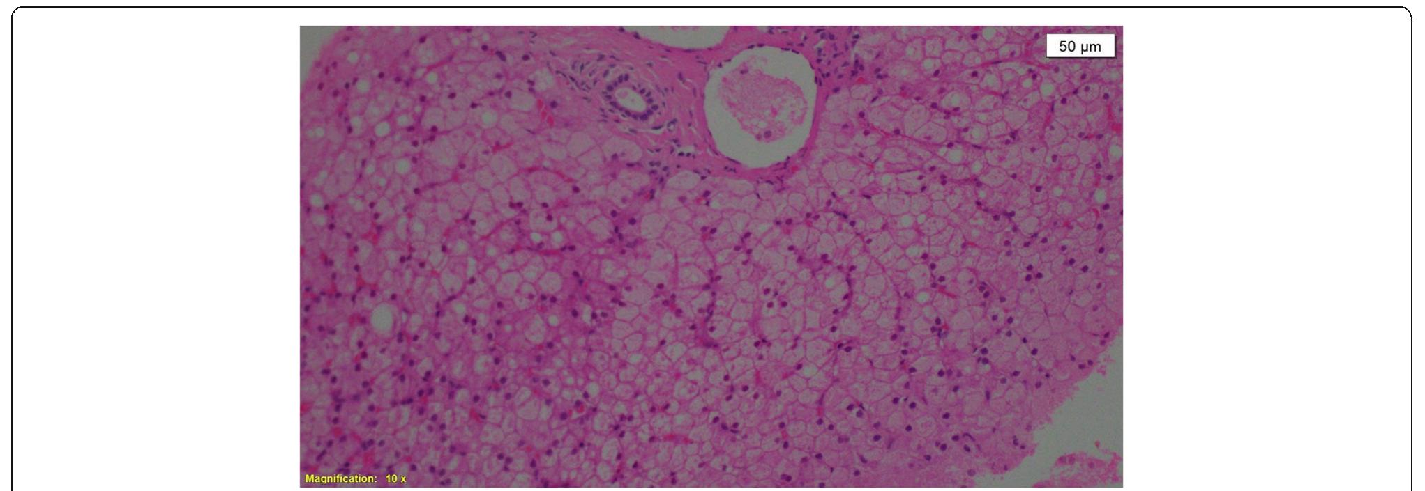 Liver biopsy showed normal portal tract, liver cells