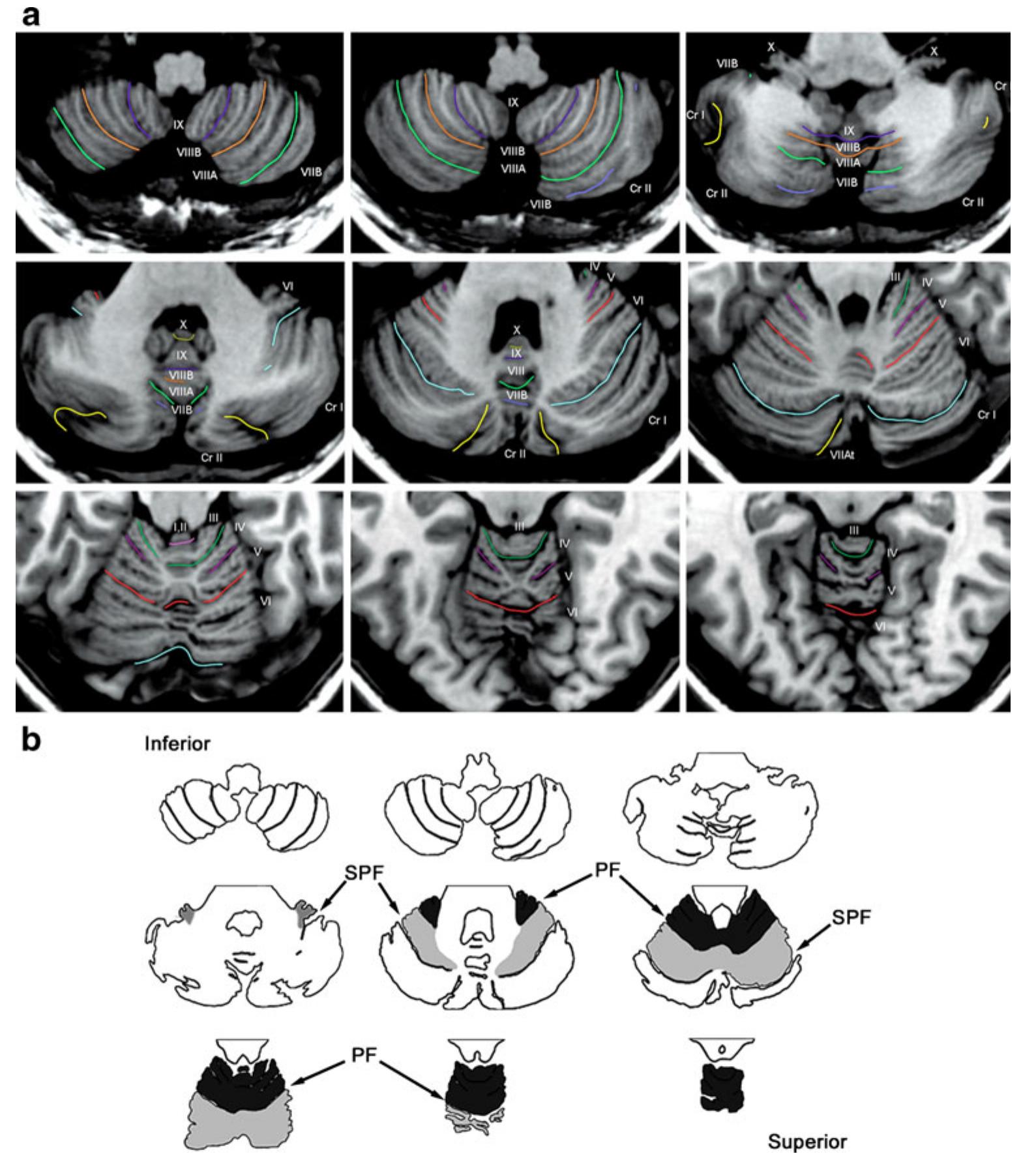 A selected horizontal mri images through the cerebellum with