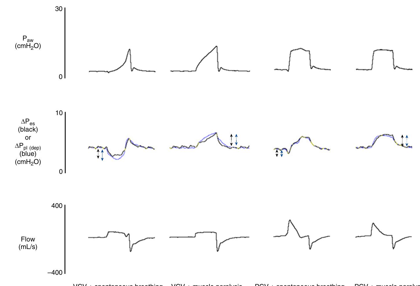 Illustrative esophageal and local pleural pressure in normal