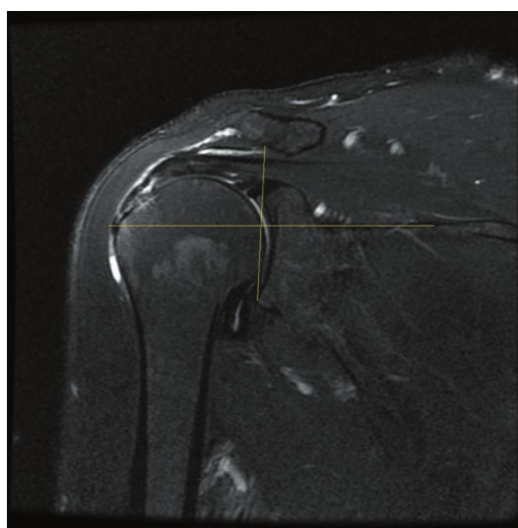 A coronal oblique mri of a patient with a rotator cuff tear.
