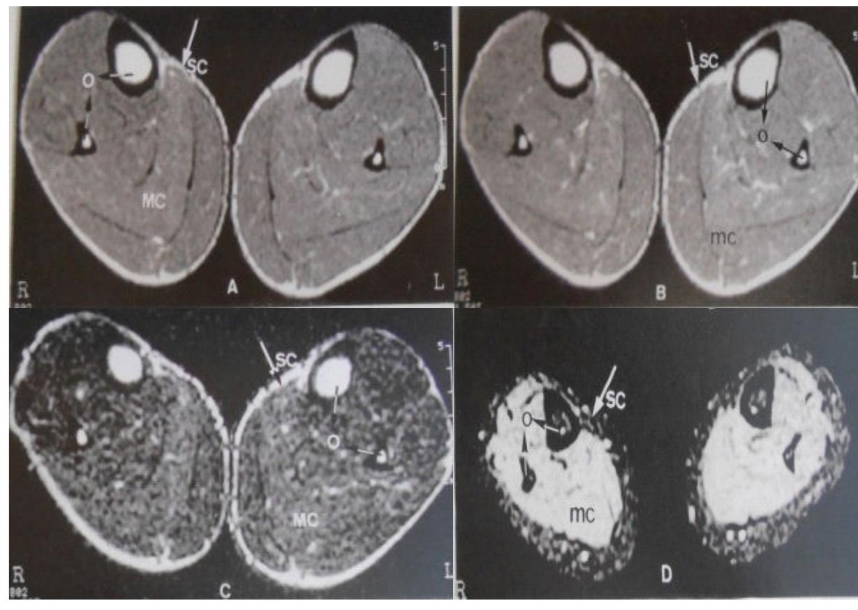 Normal tissue in mri in axial sections in the "spin echo"