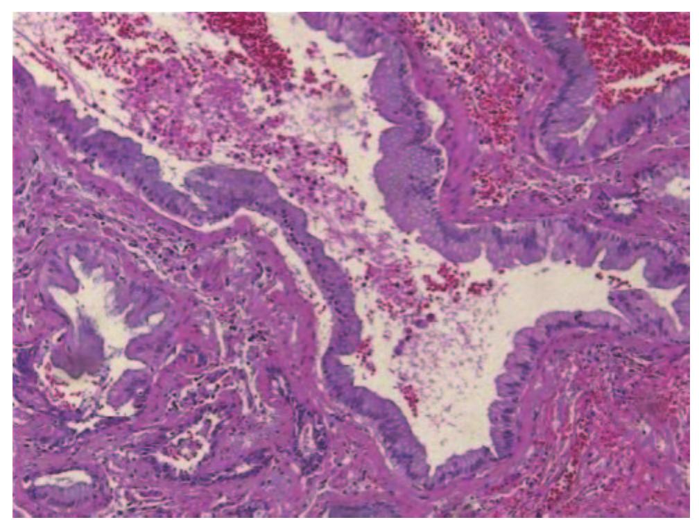 Bronchoalveolar carcinoma lining normal alveolar structure.