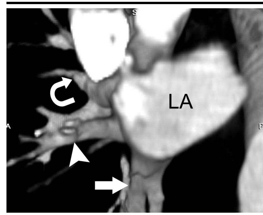Anterior coronal-oblique shaded-surface ct scan of the left