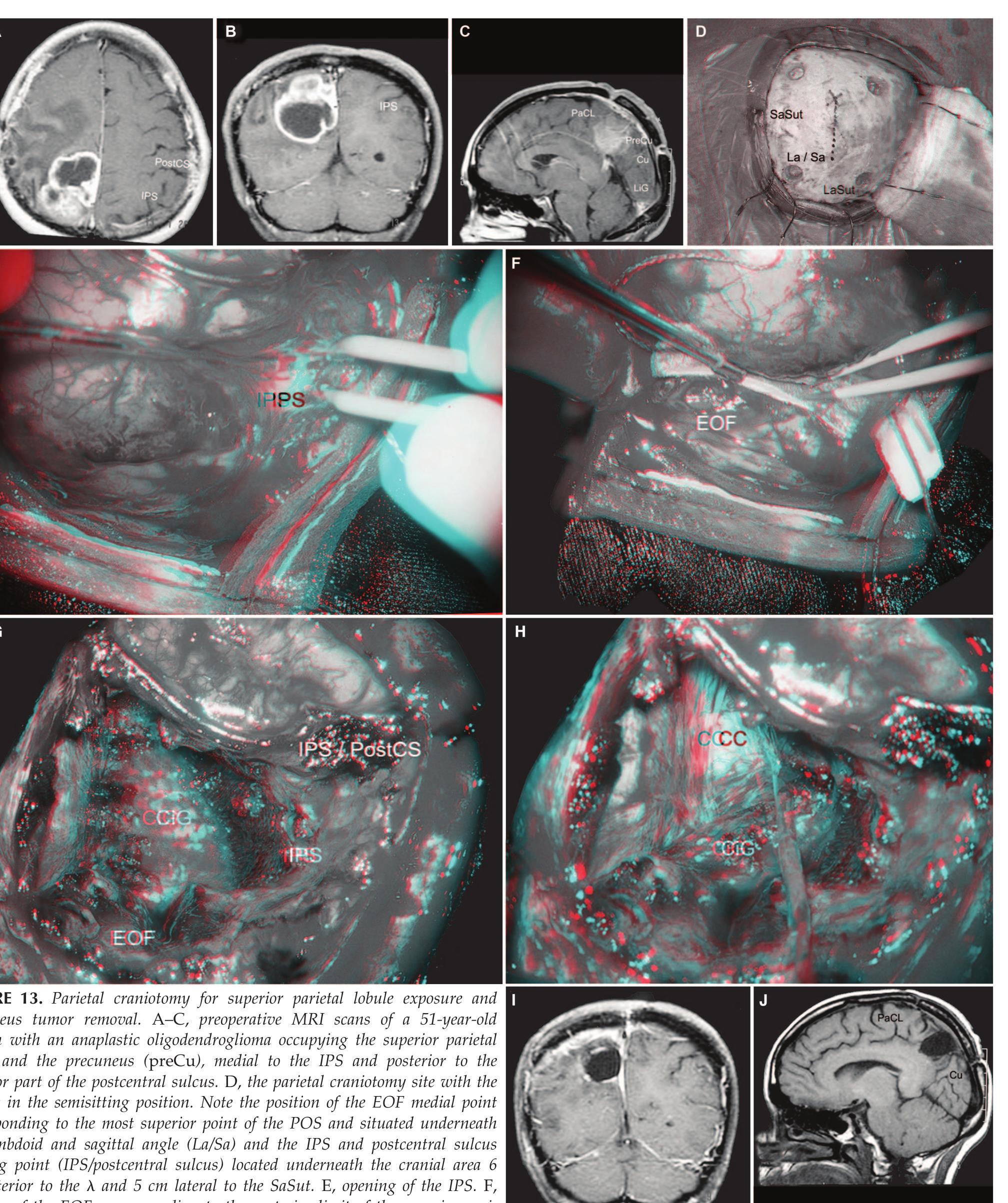 Figure 14 - Surgical Anatomy of Microneurosurgical Sulcal