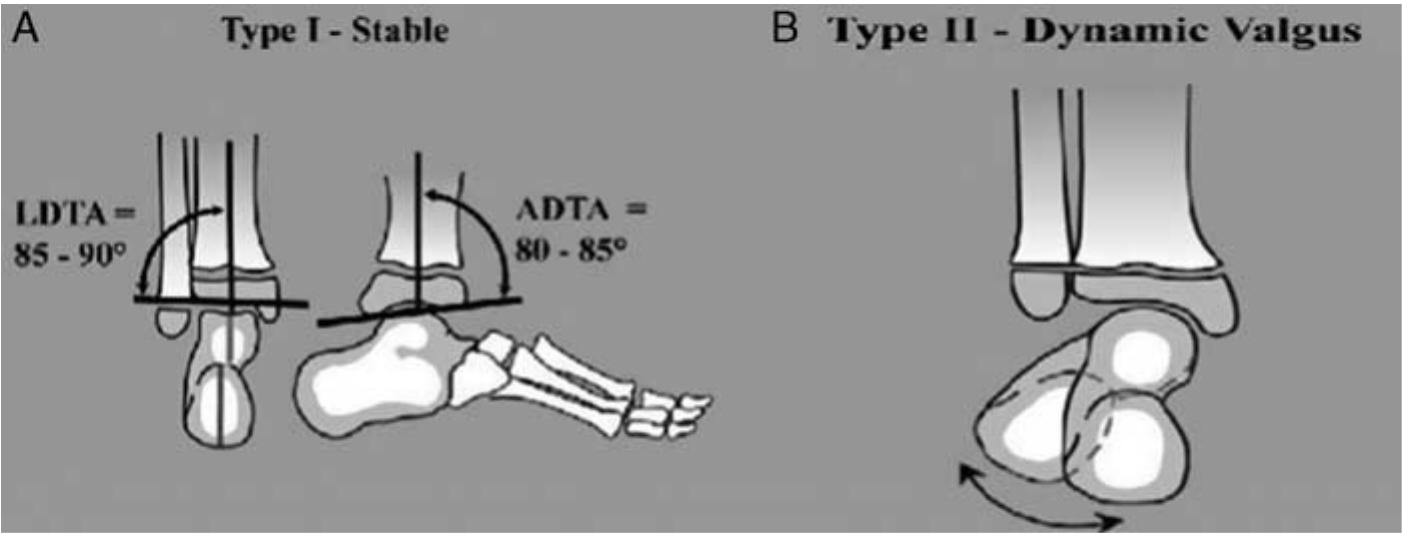 Paley’s classification type 1: tibial shortening alone with