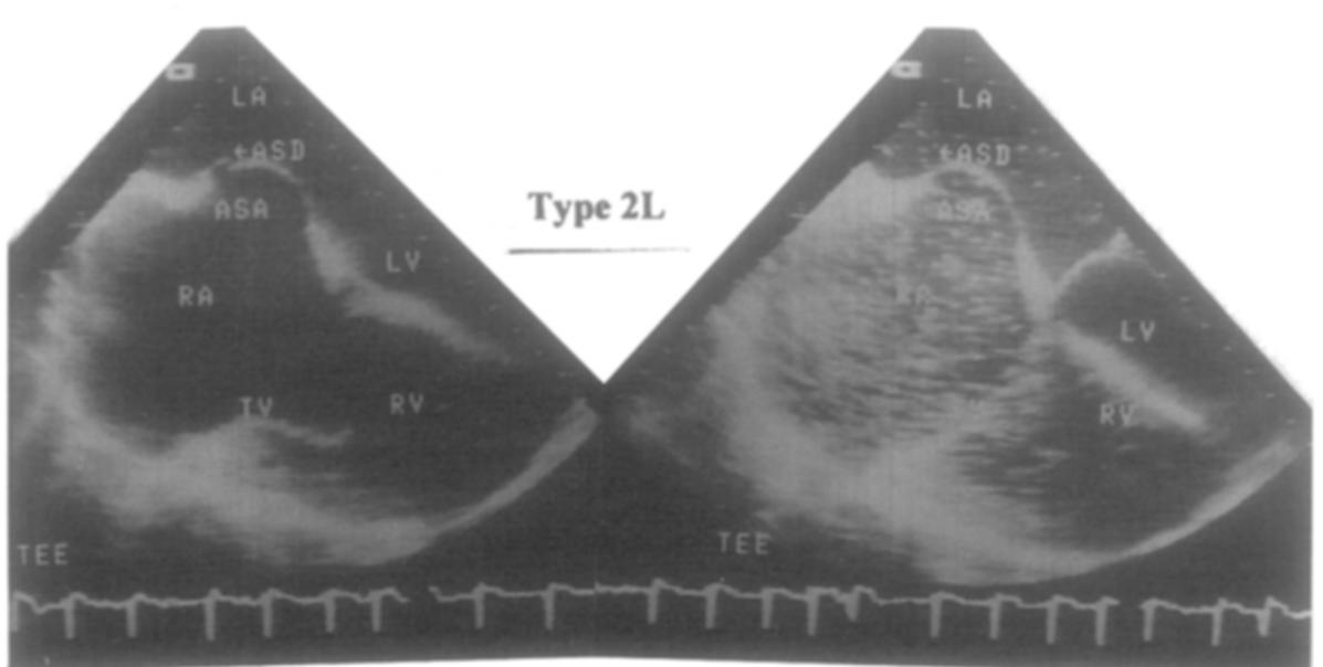 A patient with an atrial septal aneurysm (asa) type 2l