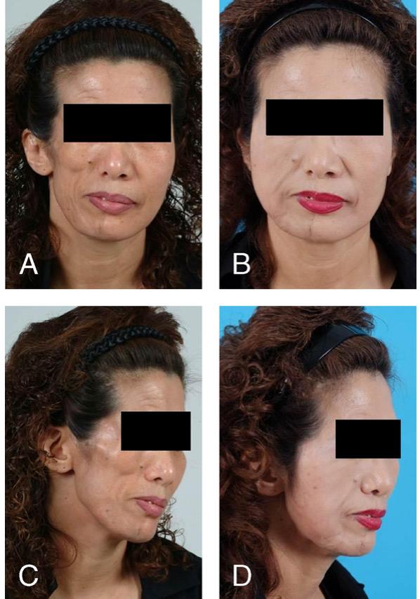 A and c, frontal view and lateral view in a 55-year-old
