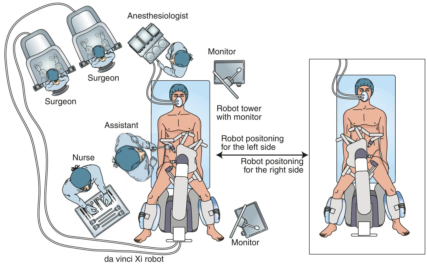1 patient positioning and robotic setup for total colectomy.