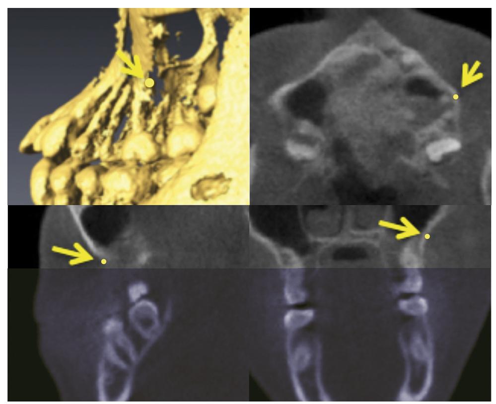 Alveolar bone (aib): outer cortex of alveolar bone adjacent
