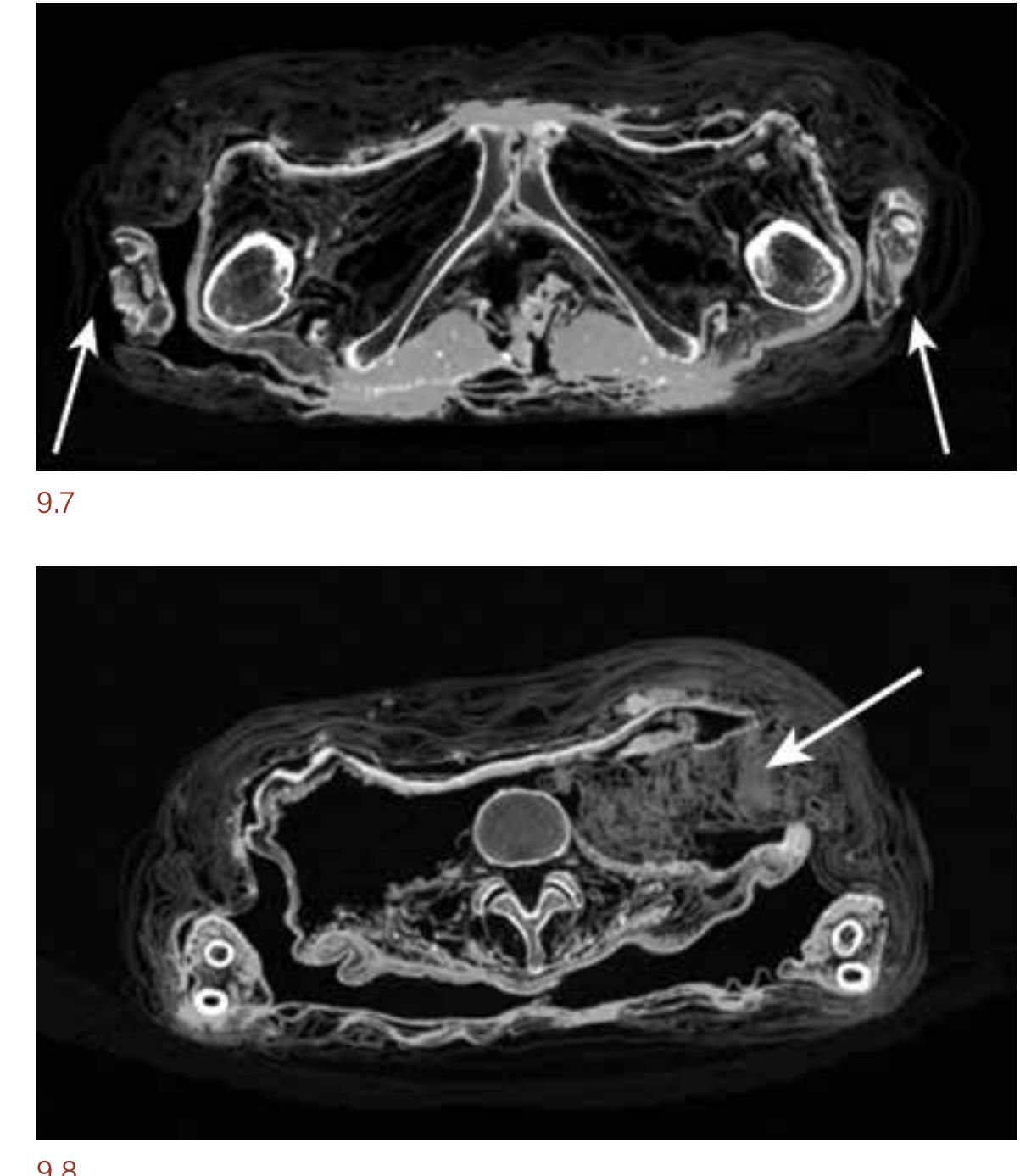 8 axial ct image of the lower abdomen, showing the