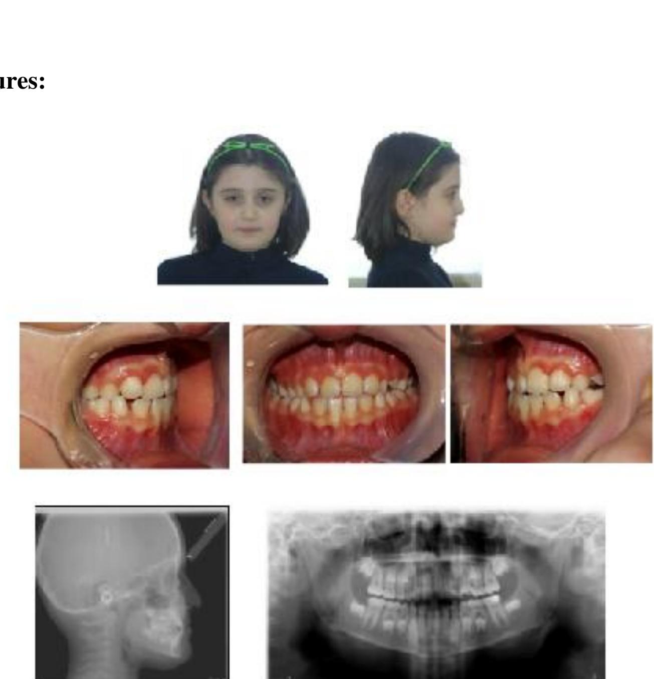 Figure 1 - Treatment of Skeletal Class III Malocclusion