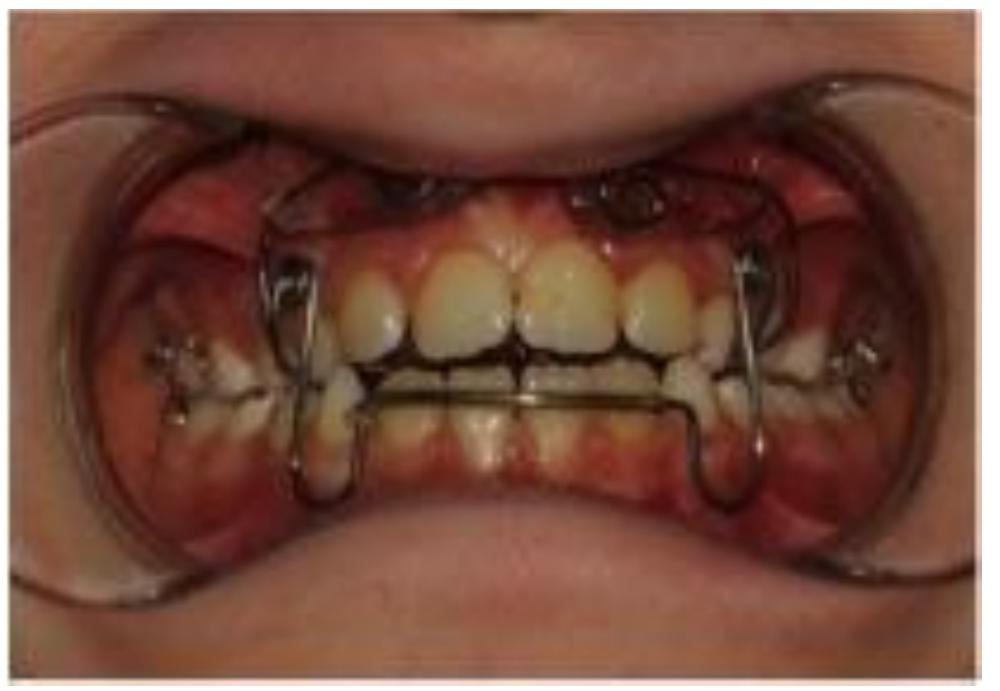 Figure 5 - Treatment of Skeletal Class III Malocclusion