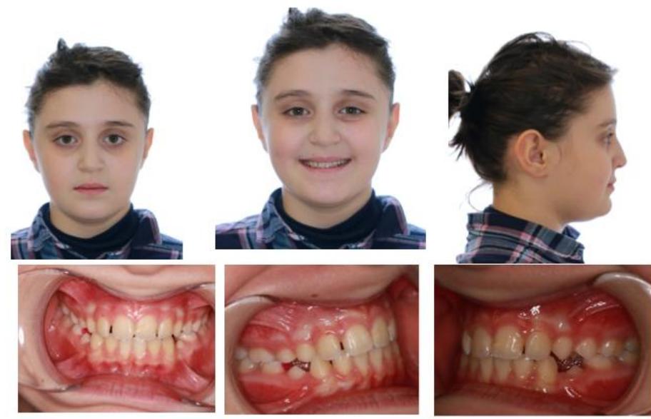 Figure 7 - Treatment of Skeletal Class III Malocclusion