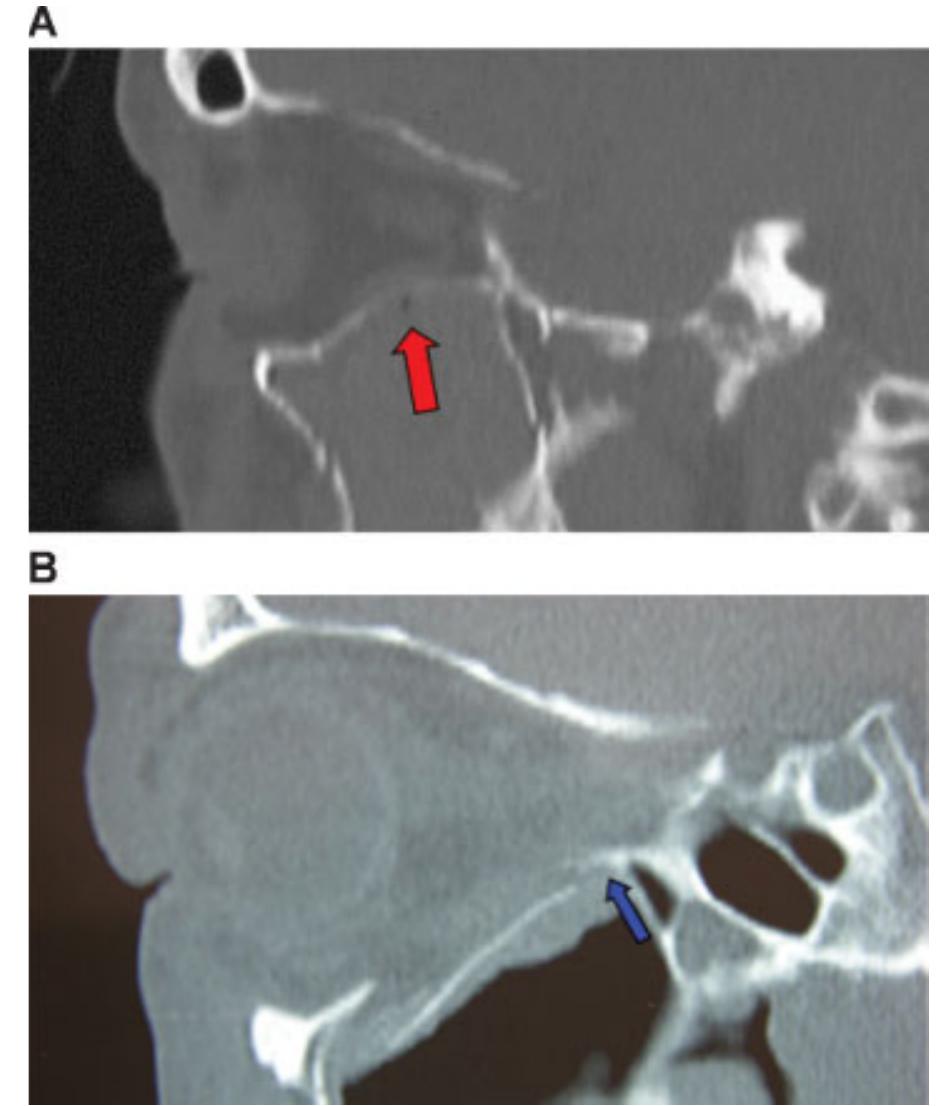 Assessment of intraorbital landmarks. (a) the intact retro-
