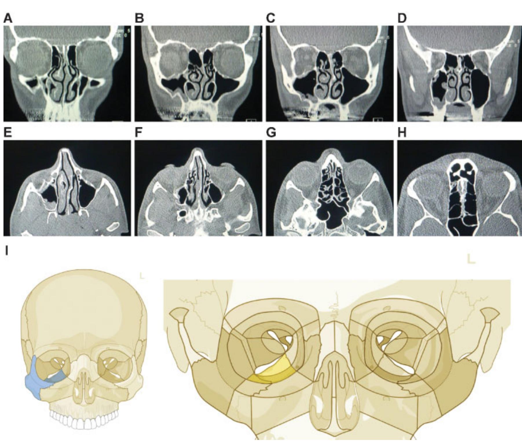 Zygoma fracture on the right side. imaging: ct scan coronal