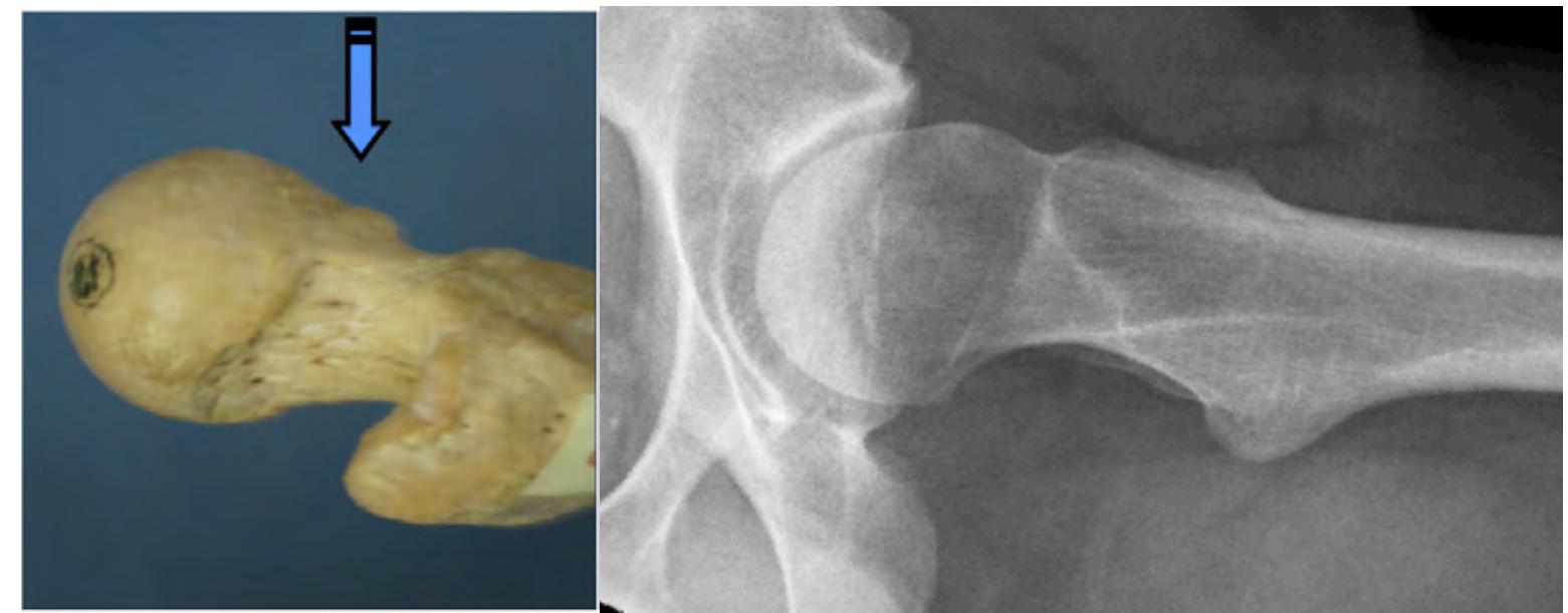 Cam lesion as seen in skeletonized specimen and frog leg