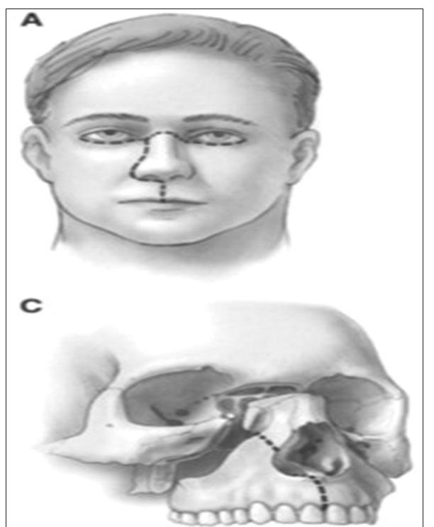 Transnasomaxillary osteotomy - level iv