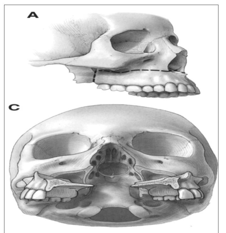 Transmaxillary osteotomy - level v