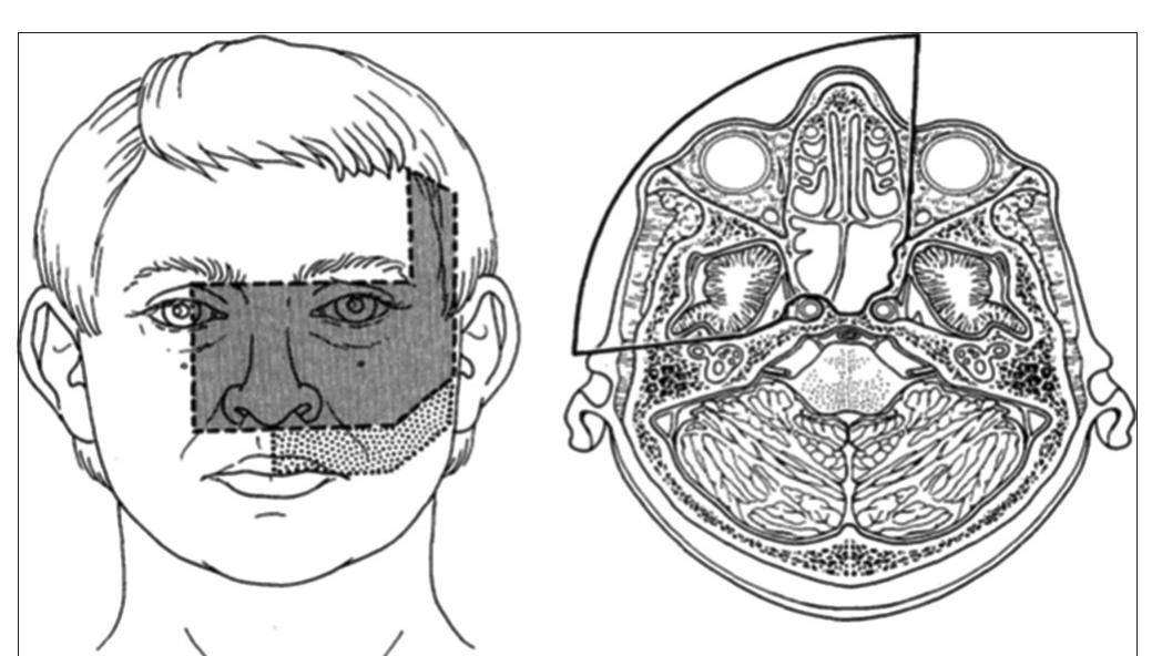 Extended facial translocation - medial it incorporates the