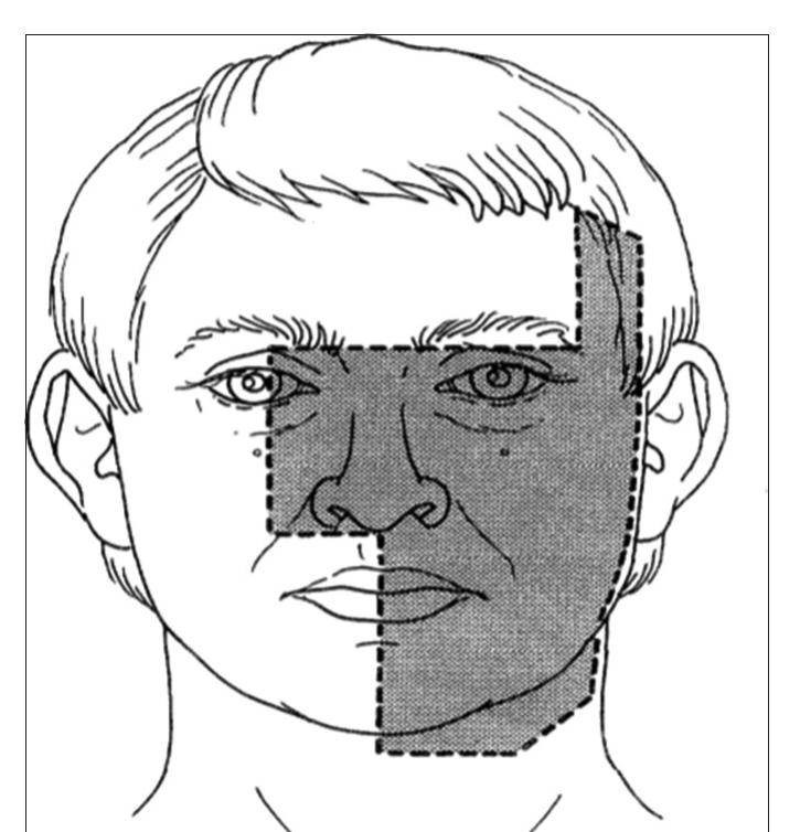 Extended facial translocation - medial and inferior