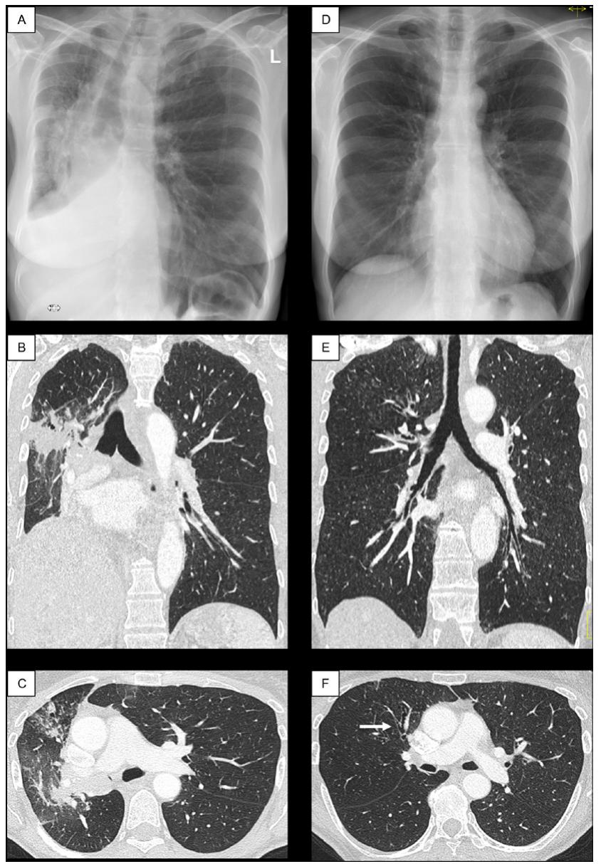 (a) chest radiograph demonstrating bronchial cut of sign and