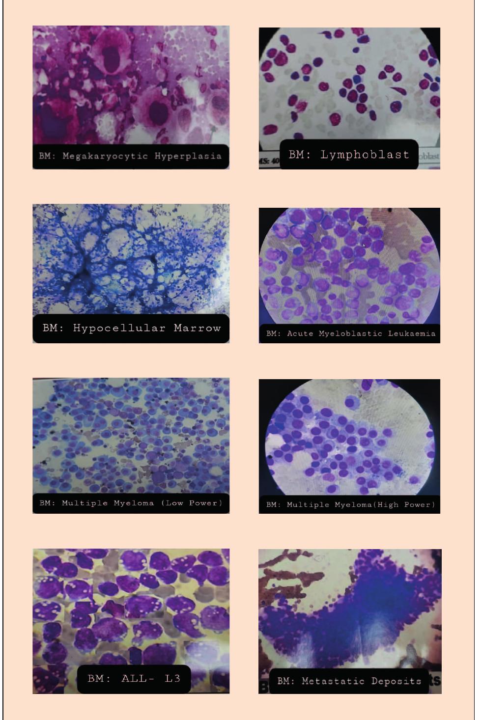 -3: pictograms of different findings of bone marrow